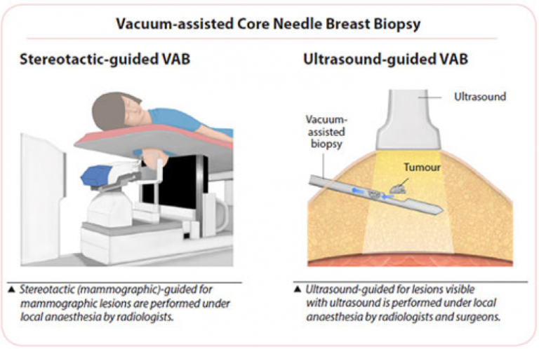 Breast Lumps Breast Biopsy K W Ong Breast And General Surgery K W